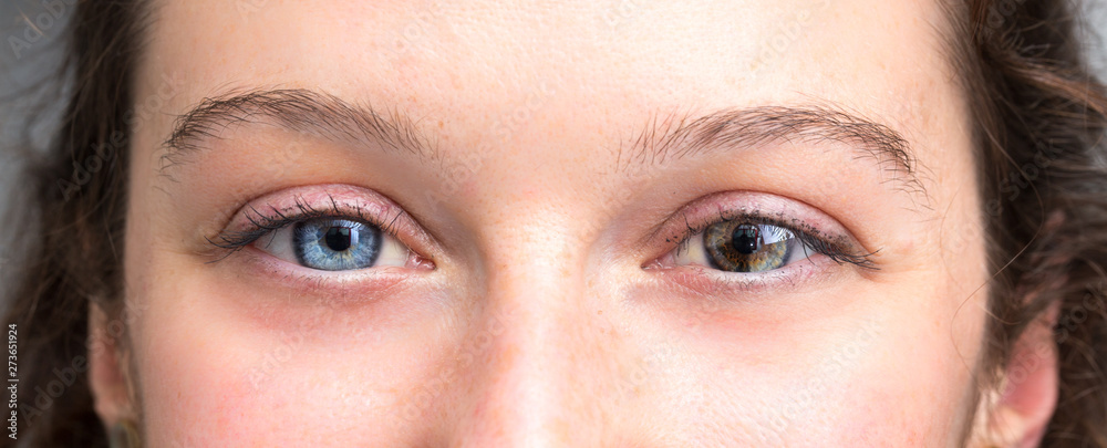 Human heterochromia iridium, woman eyes showing difference in ...