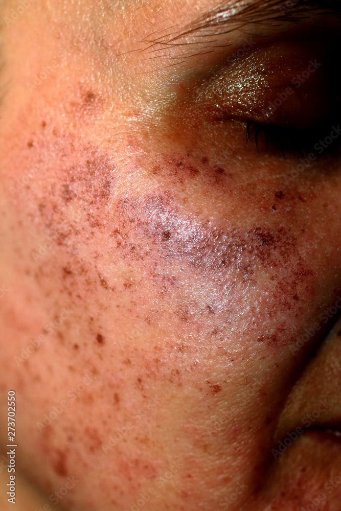 Pigmented spots on the face. Pigmentation on cheeks Stock Photo | Adobe ...