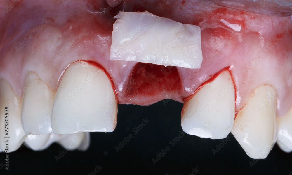 adding a flap of their patient's soft tissues to increase the volume ...