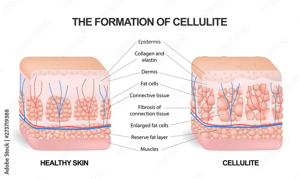 Cellulite Diagram