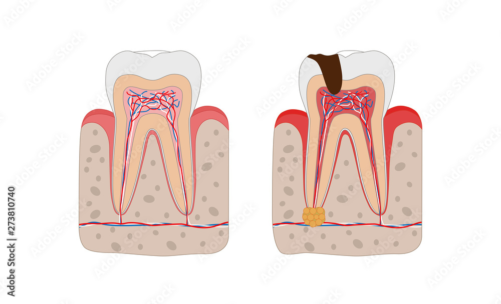 Healthy tooth and unhealthy tooth with tooth decay and dental abscess ...