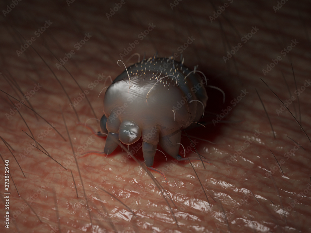 3d rendered medically accurate illustration of a scabies mite on human ...