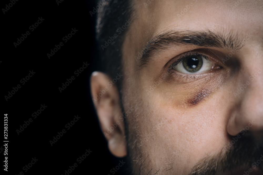 Man with bruise eye hematoma. Wounded victim with black eye. Stock ...