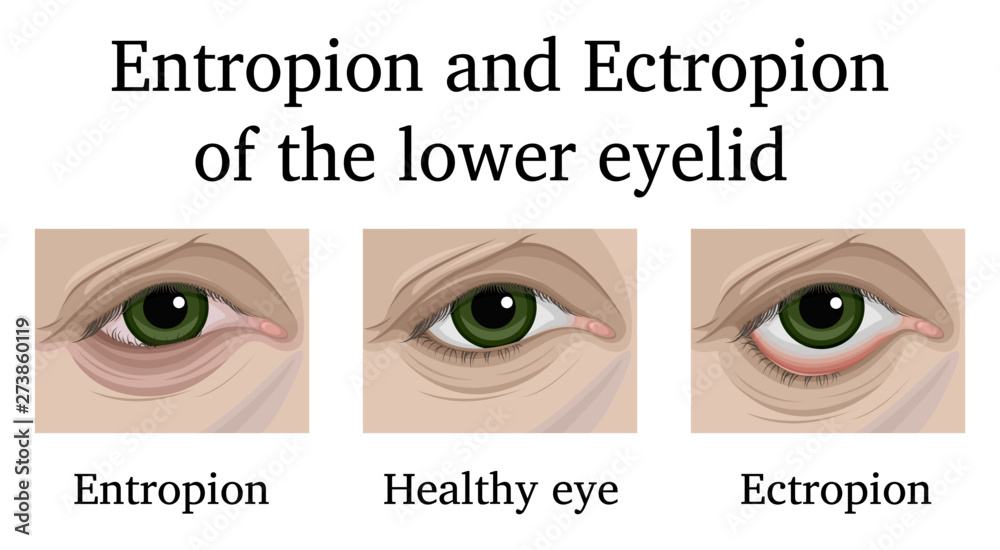 Entropion and Ectropion of the lower eyelid Stock Vector | Adobe Stock