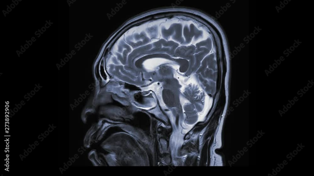 MRI of the brain sagittal plane for detect a variety of conditions of ...