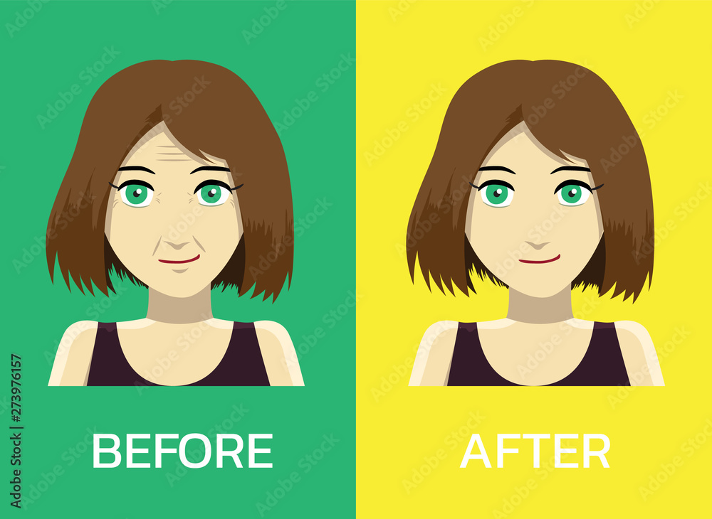 Botox Before After Face Manga Woman Cartoon Vector Illustration-01 ...