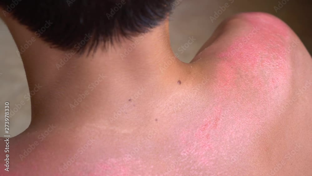 Sunburn blisters are small, white, fluid-filled bumps that appear on ...