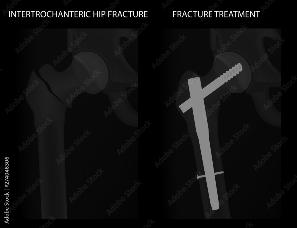 Vector illustration hip joint problem, x-ray of intertrochanteric hip ...