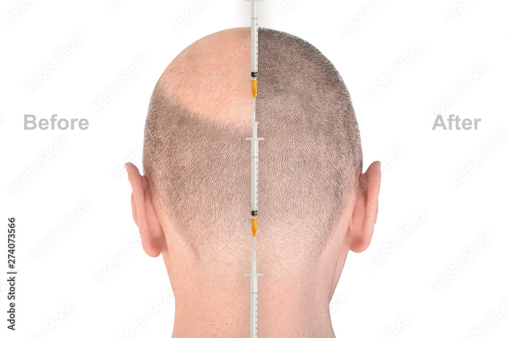 Back view of male head before and after hair extensions Stock Photo ...