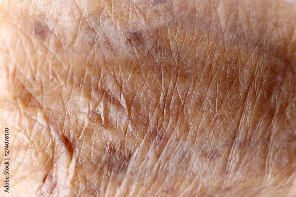 Elderly human skin, lacking moisture, wrinkled background Stock Photo ...