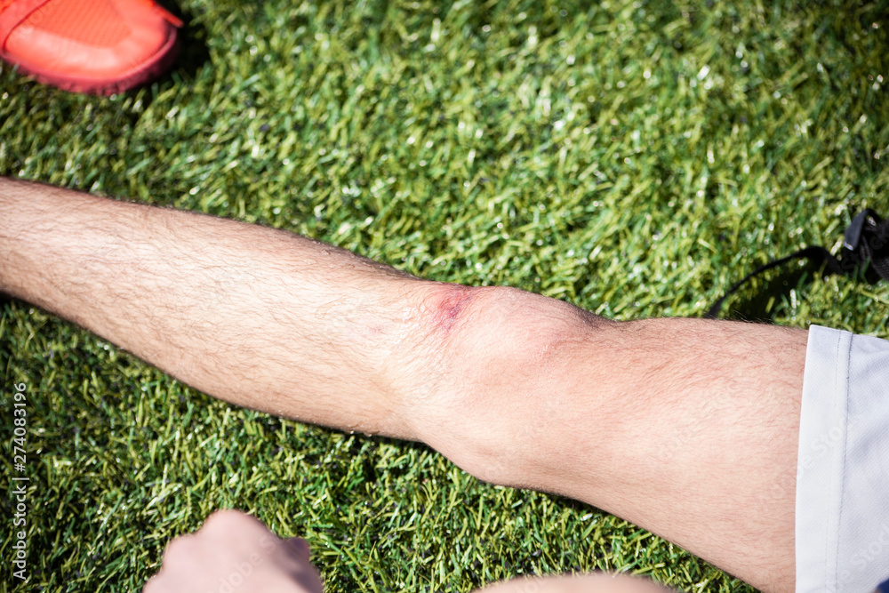 Wound on the knee. Sports injury. After the game of football. Bruised ...