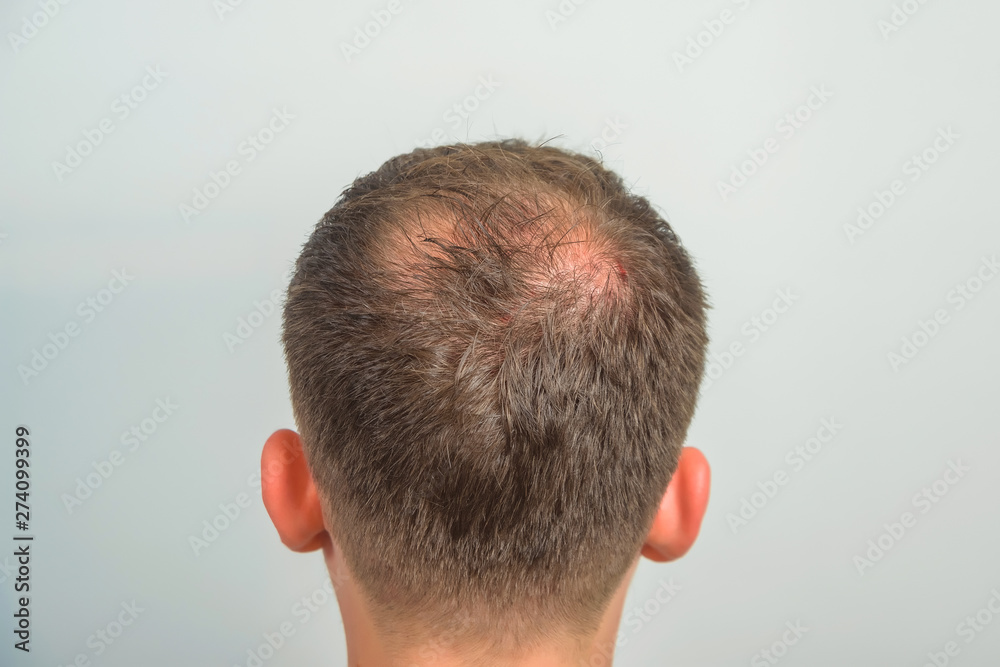 The guy in the medical office. Male pattern baldness. Mesotherapy of ...