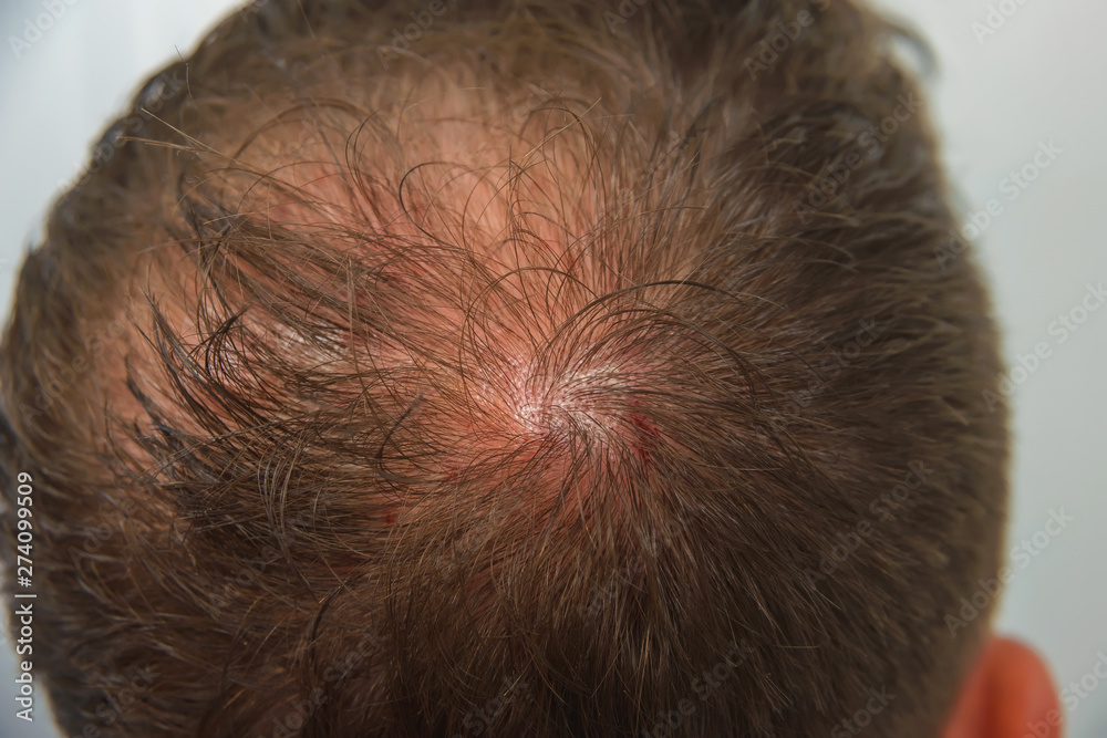 The guy in the medical office. Male pattern baldness. Mesotherapy of ...
