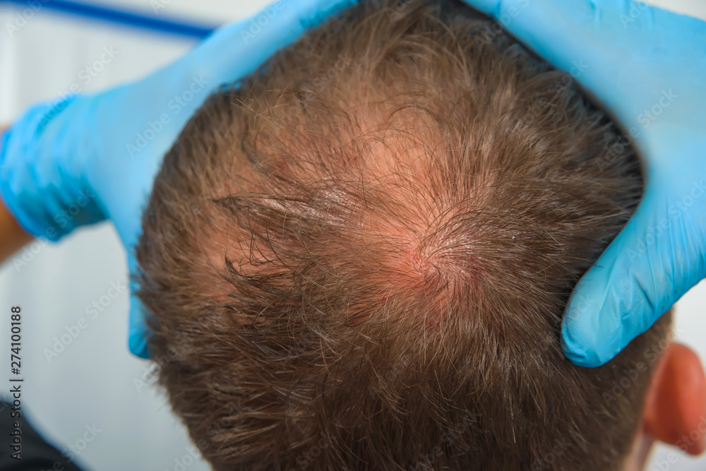 Guy in blue latex holding his head. Male pattern baldness. Mesotherapy ...