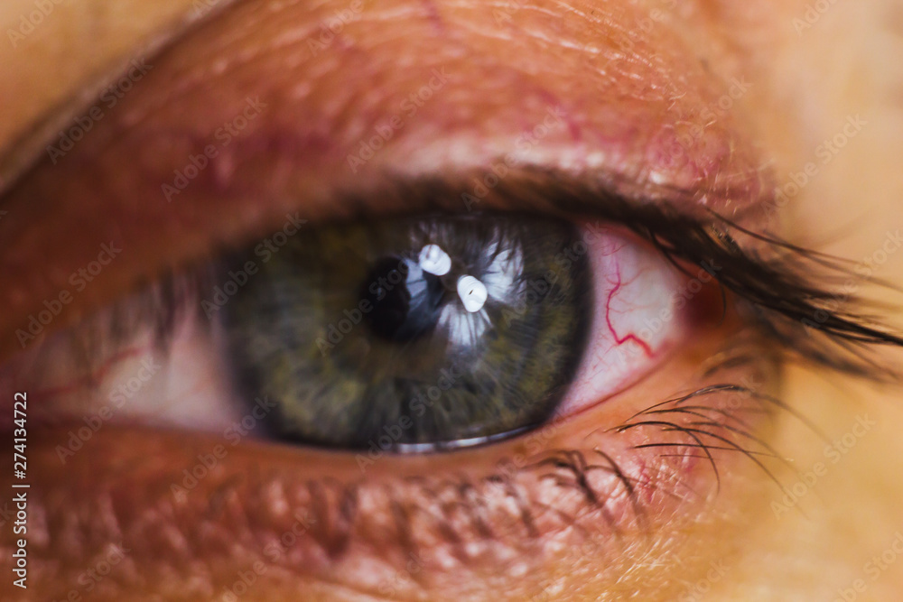 open human eye with bright red arteries close up. irritation and ...