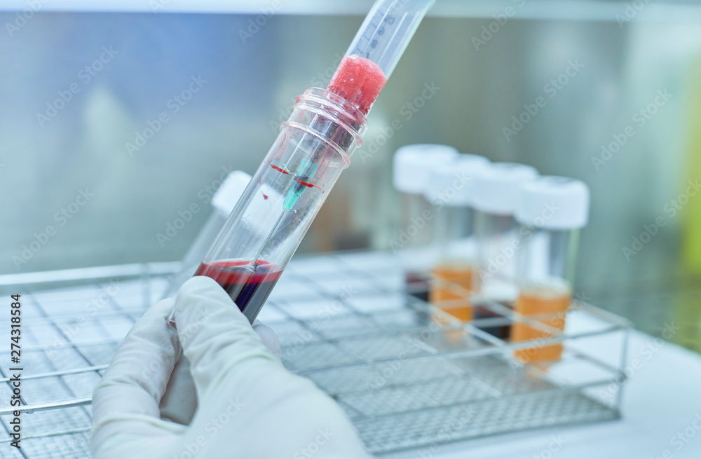 hand pouring blood in to plastic bottle, Hospital laboratory. Stock ...