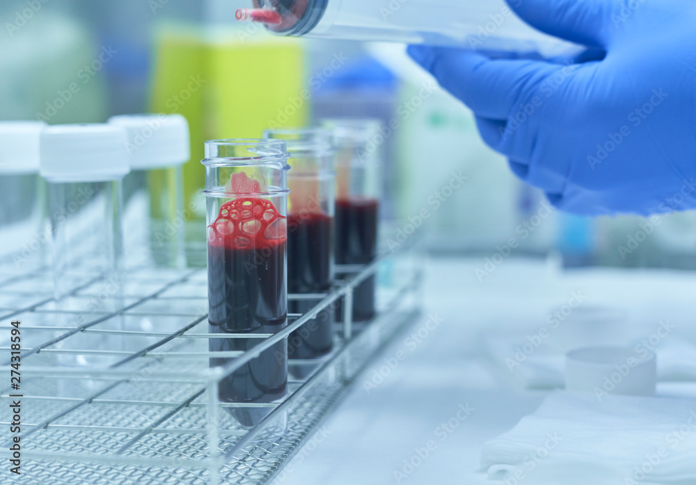 hand pouring blood in to plastic bottle, Hospital laboratory. Stock ...