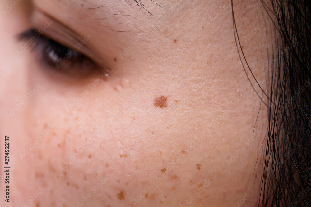 Woman 's problematic skin , acne scars ,oily skin and pore, dark spots ...