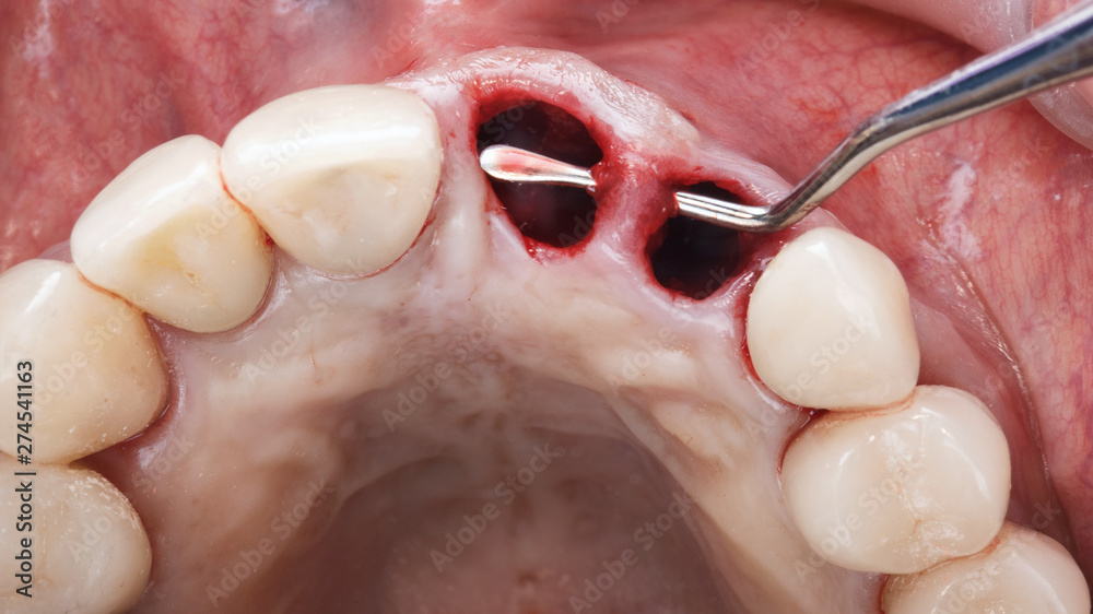 extracted two teeth before implantation and shows the volume of the ...