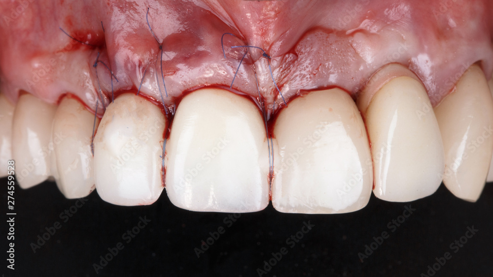 stitched and taut gums with crowns of the front teeth after ...