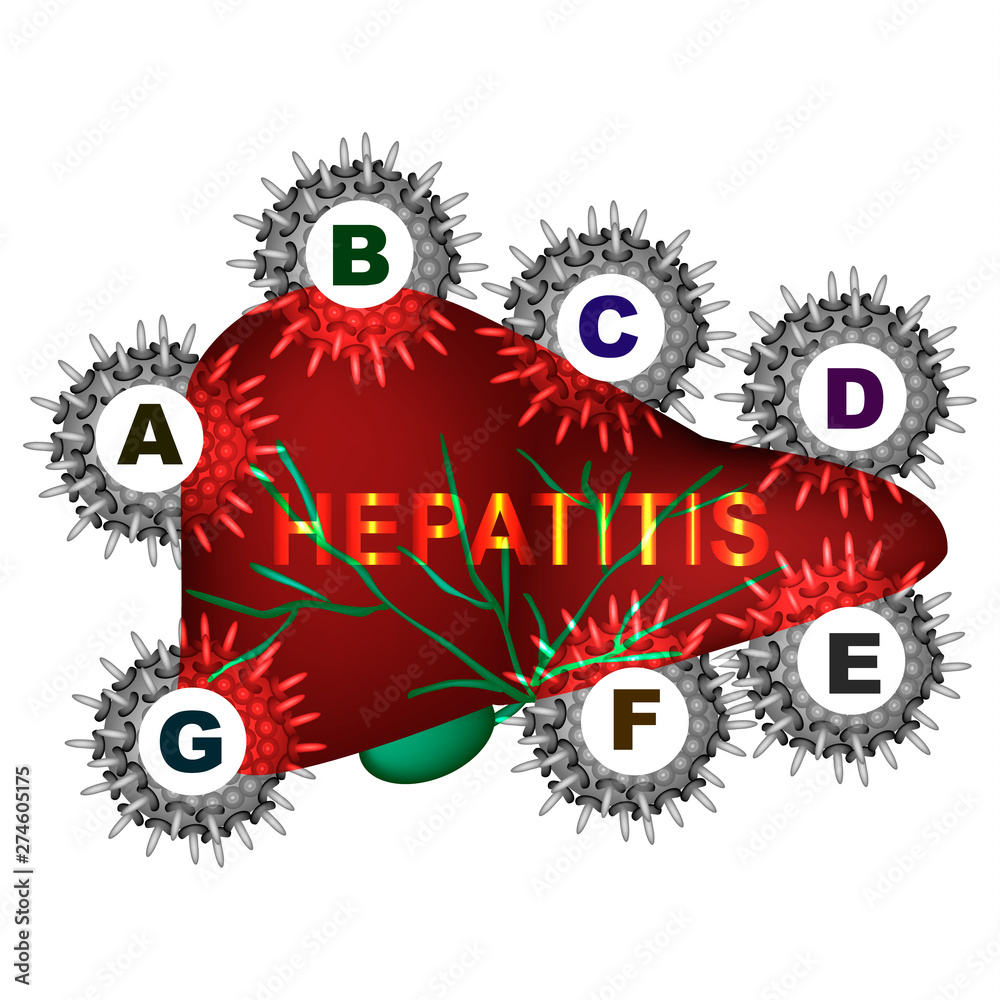 Types of viral hepatitis. Hepatitis A, B, C, D, E, F, G. World ...