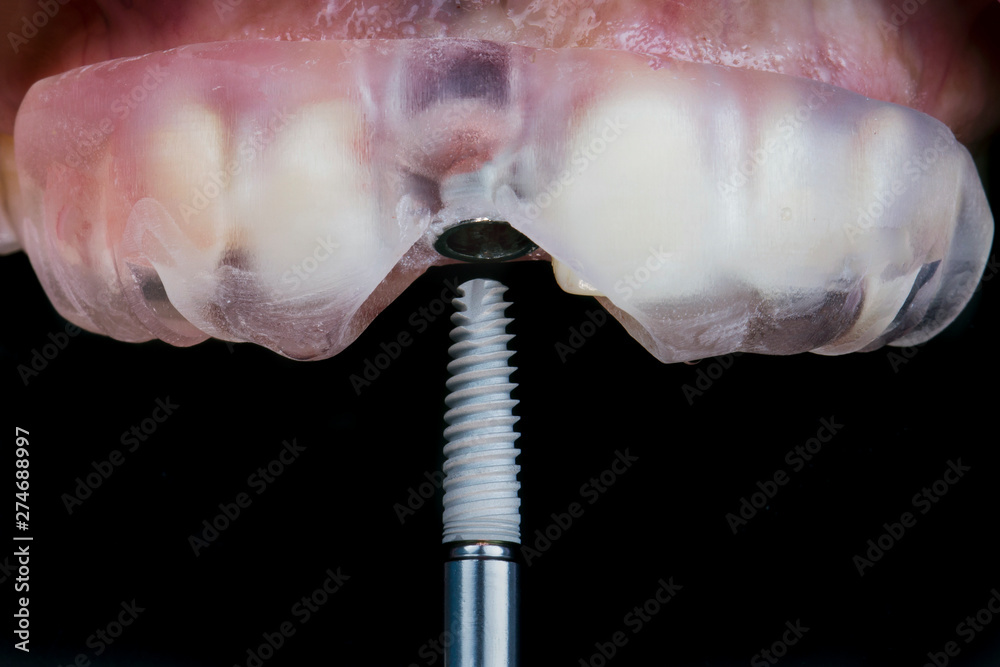 excellent frame of the surgical template and dental implant of medium ...