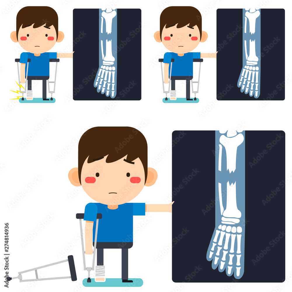 Leg x-ray Tiny cute cartoon patient man character right leg broken in ...