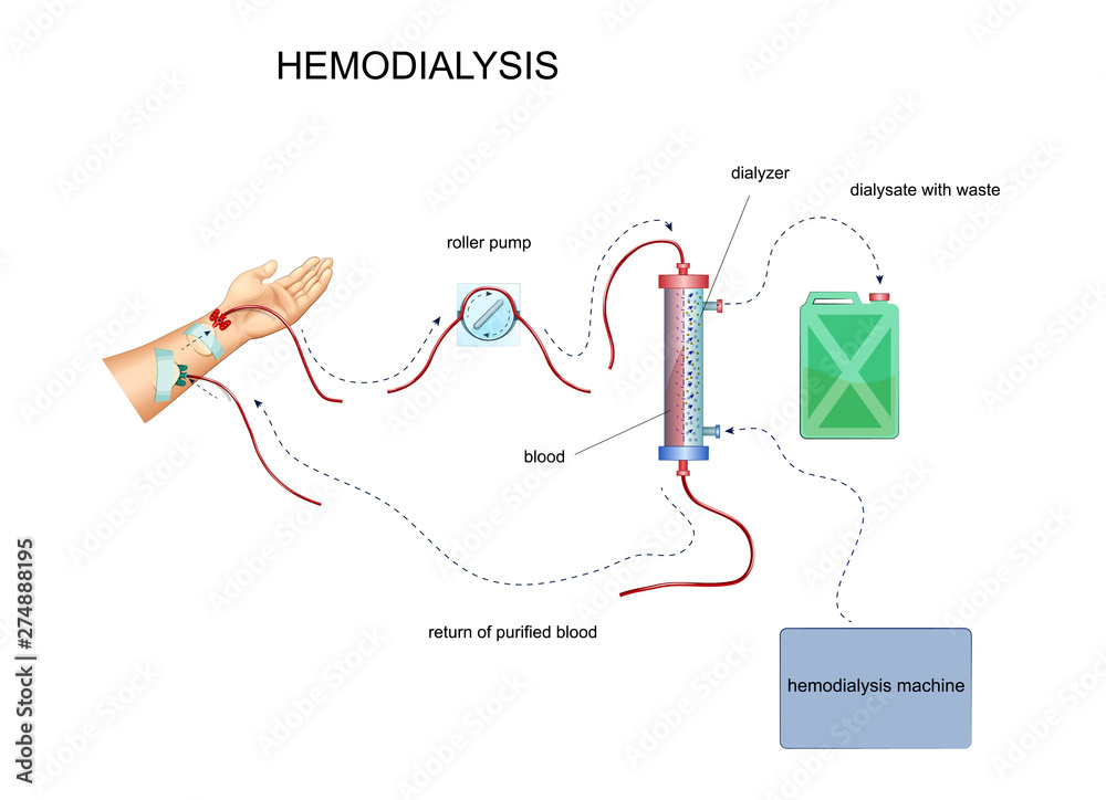 Hemodialysis Diagram