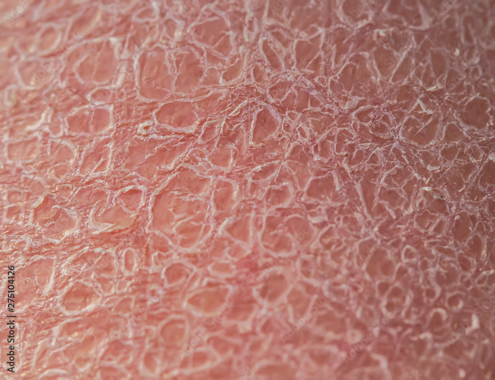 Background Of Dry Unhealthy Skin Texture Close Up Covered With Small
