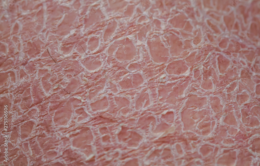 texture of women's skin close-up covered with small and large cracks ...