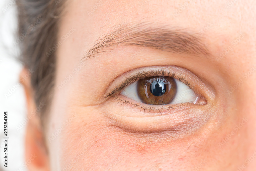 Close up view on the swollen and puffy eye of a female causing eye bag ...