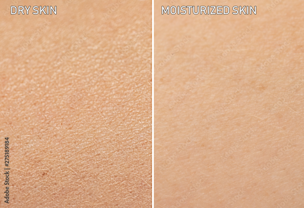 Foto De An Extreme Close Up View Of Human Skin Before And After