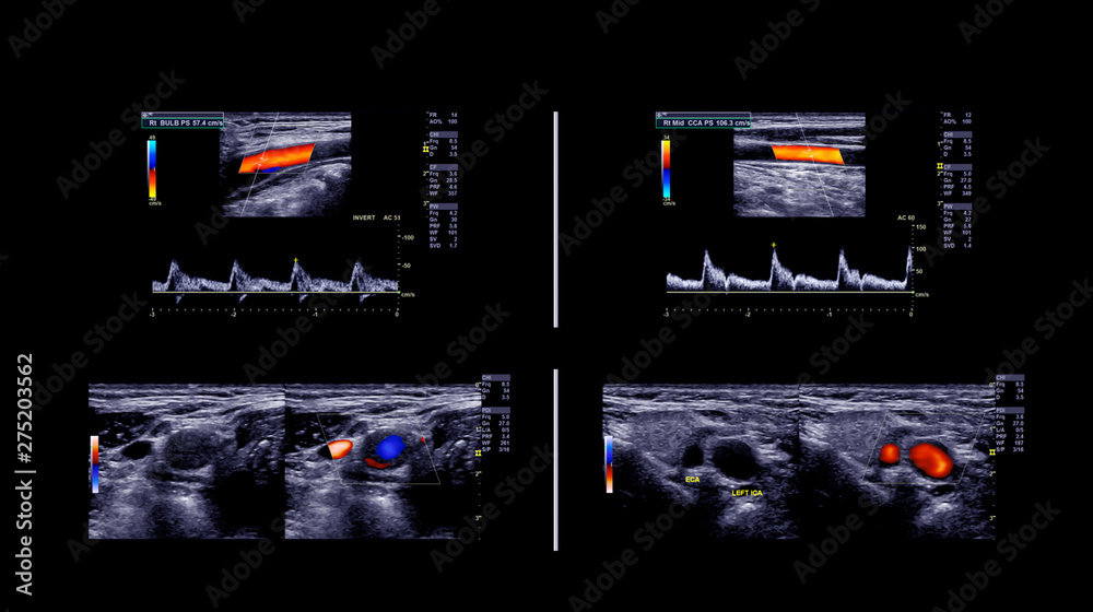 Ultrasound doppler for finding deep vein thrombosis. Stock Photo ...
