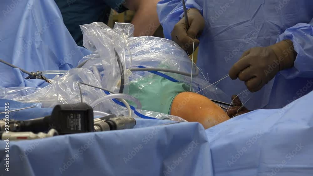 Anterior cruciate ligament reconstruction (ACL reconstruction) is a ...
