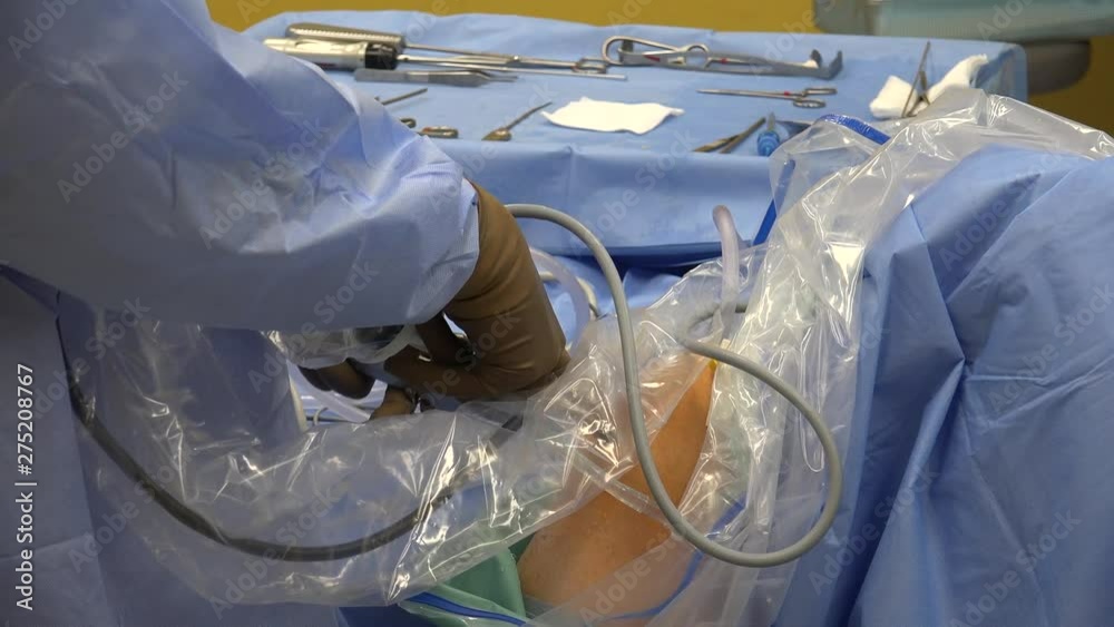 Video „Anterior cruciate ligament reconstruction (ACL reconstruction ...