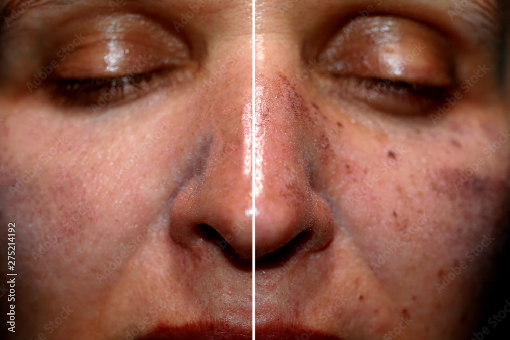 One half of the face in pigmentation and brown spots, the other side of ...