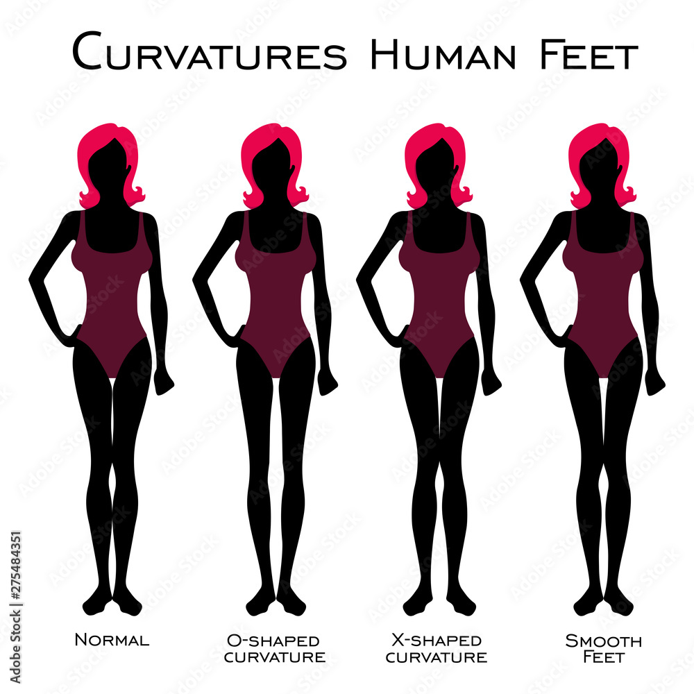 4 silhouettes of a female figure. Types of curvature of human legs ...