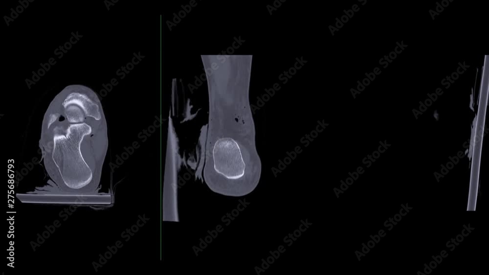 CT ankle joint or CT Scan of Right ankle comparison axial, coronal and ...