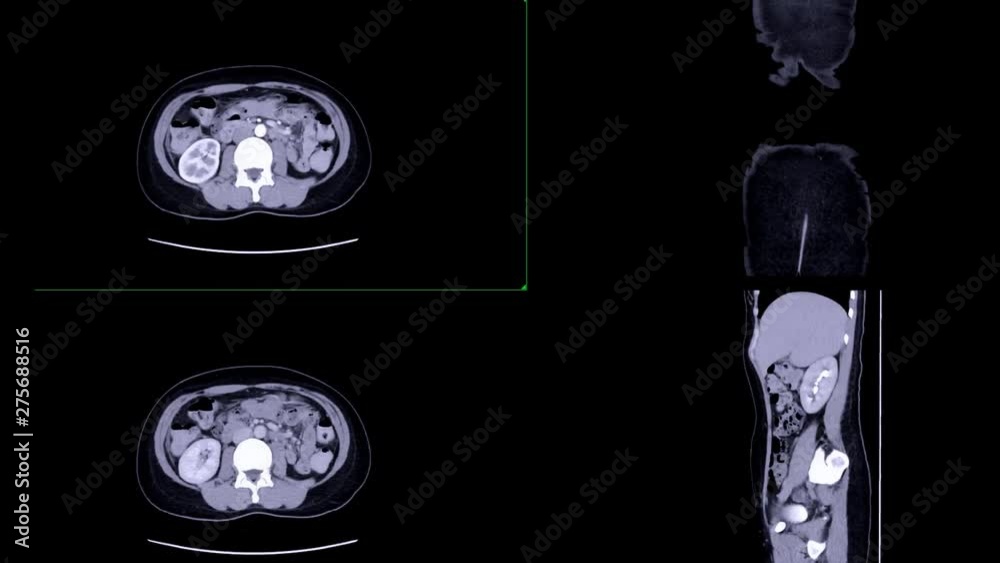 CT whole abdomen Comparison V phase and with delayed phase Axial view ...