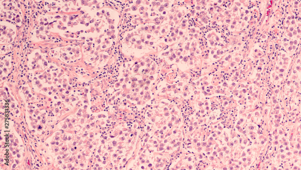 Testicular Cancer: Photomicrograph of seminoma, a malignant germ cell ...