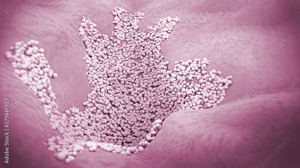 Microscopic close-up of a fungal infection of the upper skin layer ...