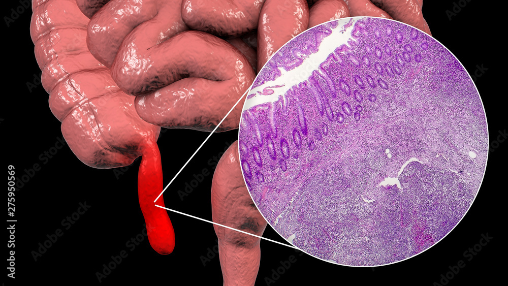 Acute suppurative appendicitis, 3D illustration of human intestine with ...