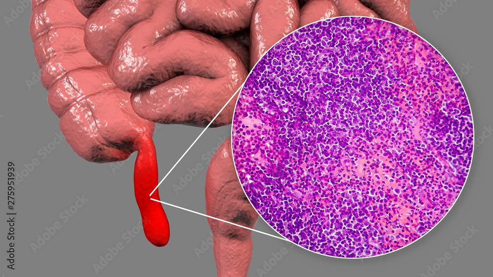 Acute suppurative appendicitis, 3D illustration of human intestine with ...