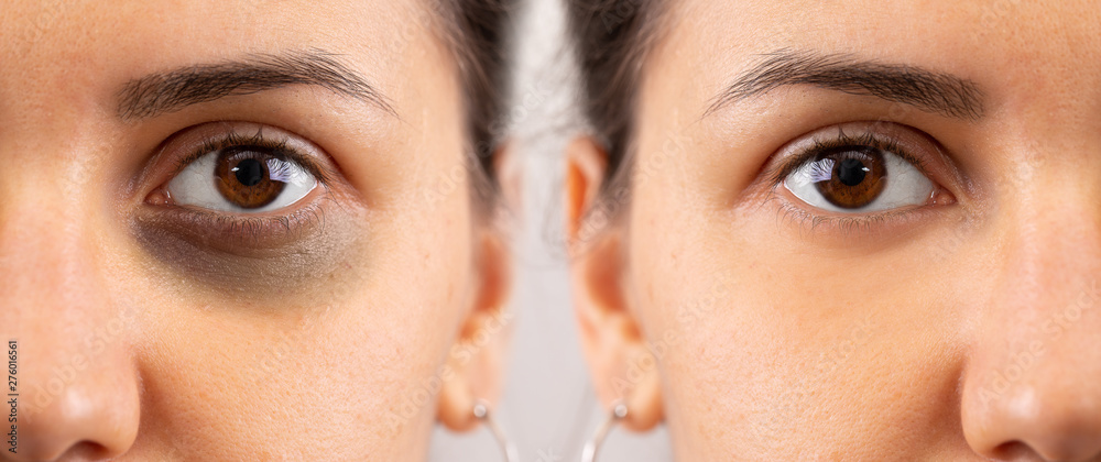 A before and after view of a pretty lady with a black eye. Healing of a ...
