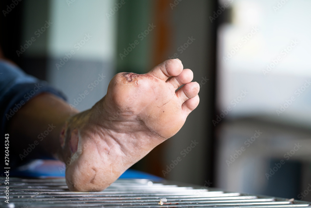 Infected diabetic foot ulcer,selective focus Stock Photo | Adobe Stock