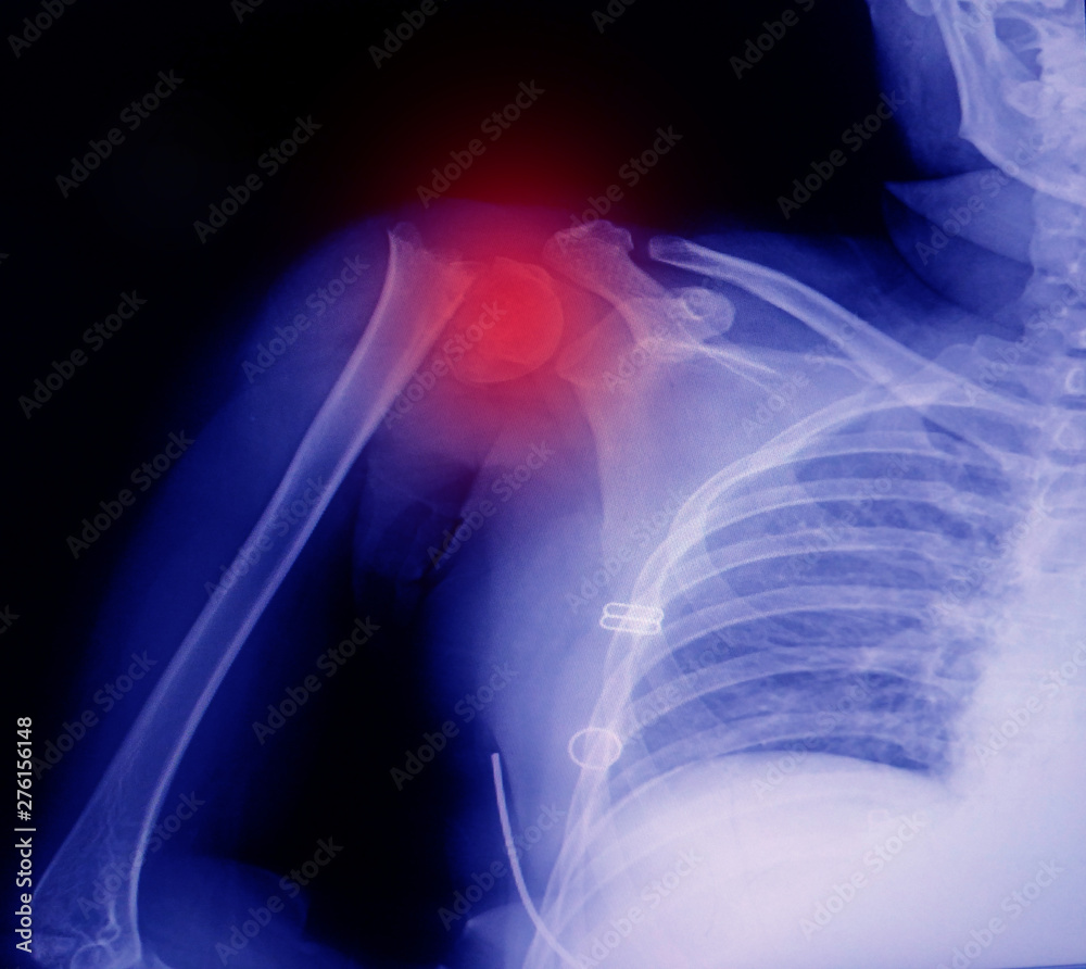 Film x ray shoulder radiograph show shoulder bone broken (neck of ...