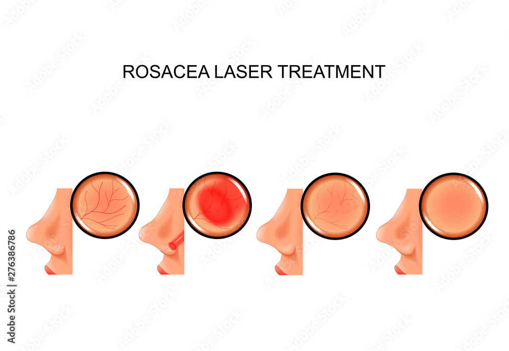 laser treatment of rosacea Stock Vector | Adobe Stock