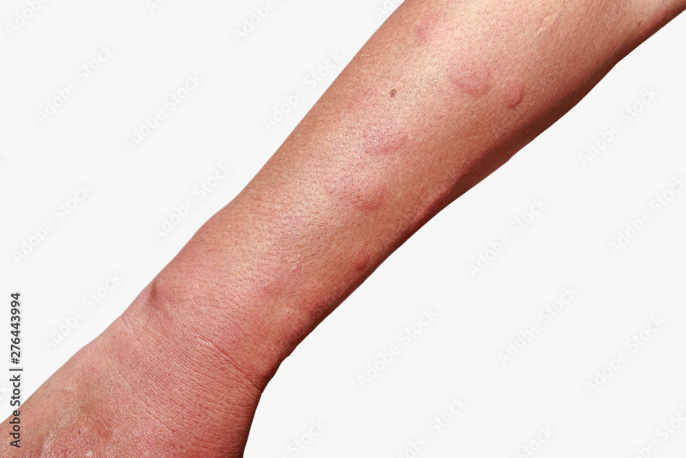 Around arm of men with dermatitis problem of rash ,allergy rash and ...