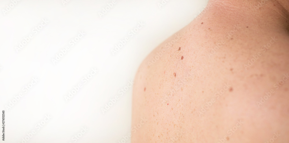 Close up detail of the bare skin on a man back with scattered moles and ...