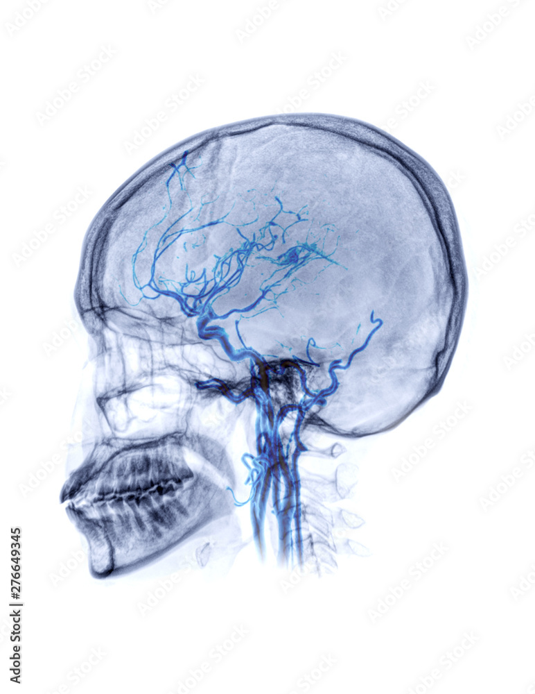 CTA brain or CT angiography of the brain 3D Rendering image fusion with ...